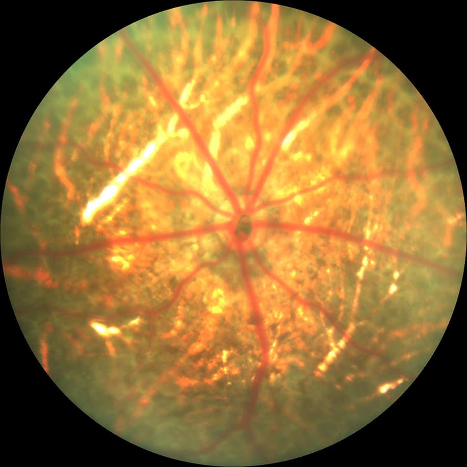 Sodium Iodate-Induced Retinal Disease Model for Dry AMD Research | Ichor